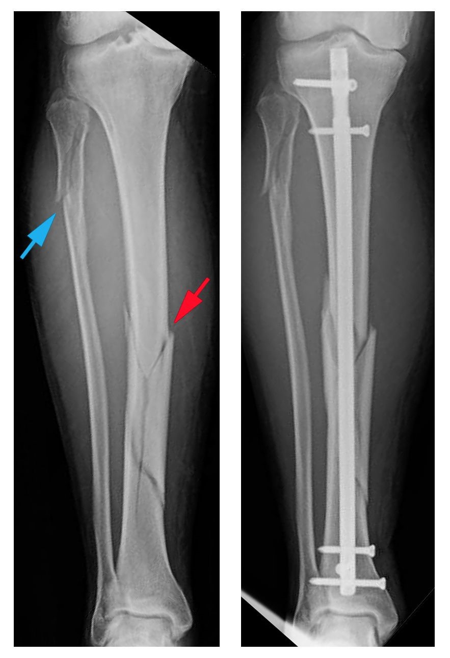 كسر قصبة الساق }}}}}}}}}}}}Tibial shaft fracture - الدكتور مازن كردية